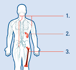 What is Chronic Lymphocytic Leukemia (CLL) | RITUXAN® (rituximab)