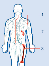 What is Chronic Lymphocytic Leukemia (CLL) | RITUXAN® (rituximab)