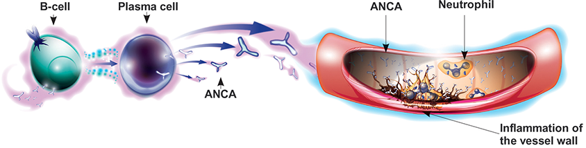 What are GPA and MPA? | RITUXAN® (rituximab)