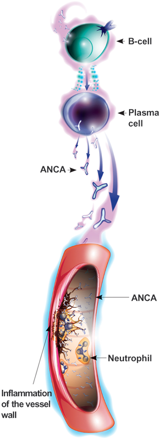 What are GPA and MPA? | RITUXAN® (rituximab)