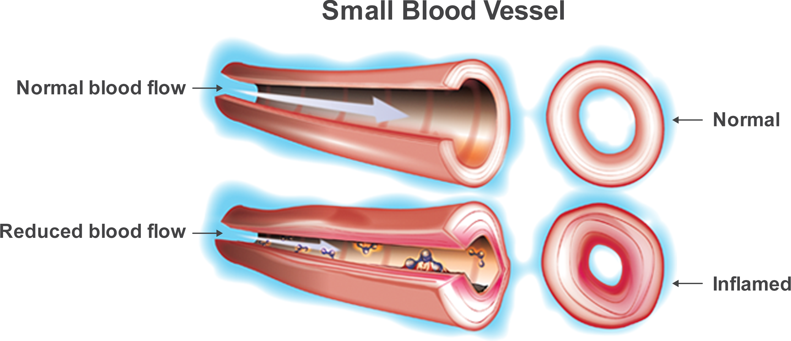 What are GPA and MPA? | RITUXAN® (rituximab)