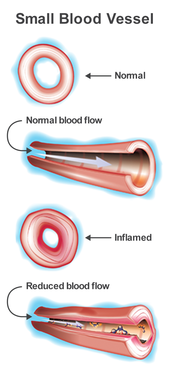 What are GPA and MPA? | RITUXAN® (rituximab)