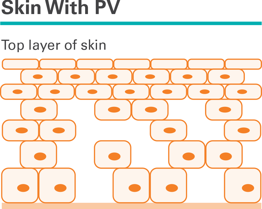 What is Pemphigus Vulgaris (PV)? | RITUXAN® (rituximab)